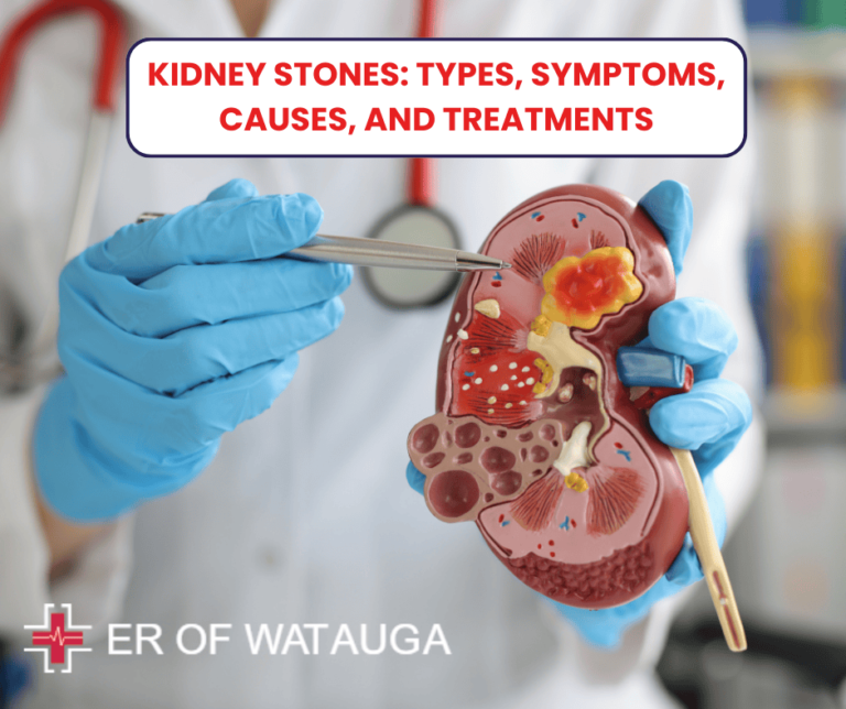 Kidney Stones: Types, Symptoms, Causes, And Treatments - ER Of Watauga